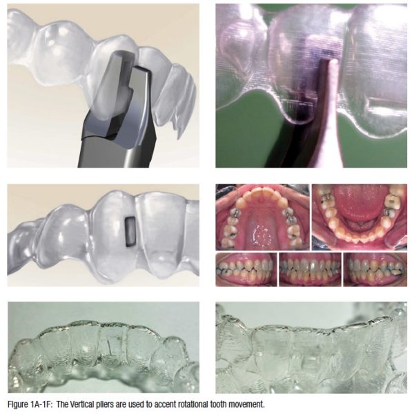 Orthodontic News - Clear Collection instruments for clear aligner ...