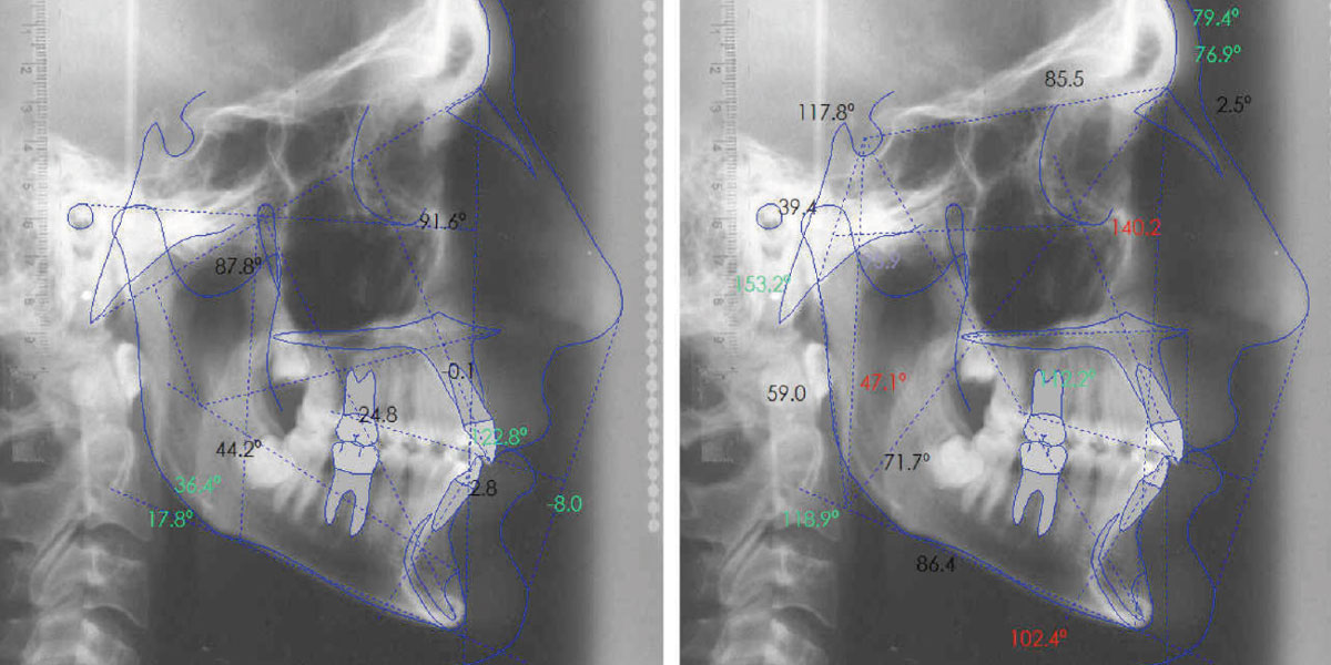 Active self-ligation for better control throughout treatment ...