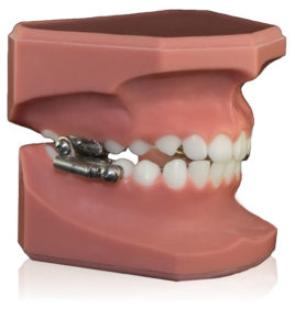 Herbst appliance update Orthodontic Practice US