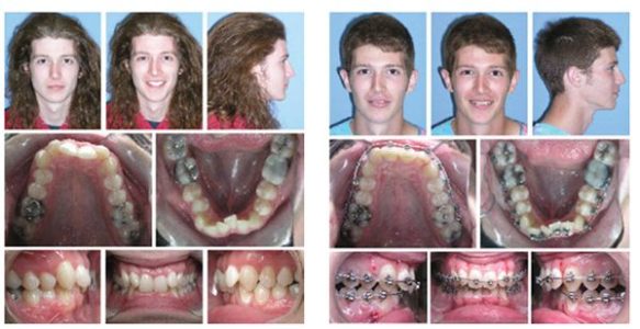 The Propel Clinical Case Challenge: case results Orthodontic Practice US