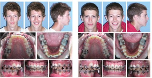 The Propel Clinical Case Challenge: case results Orthodontic Practice US