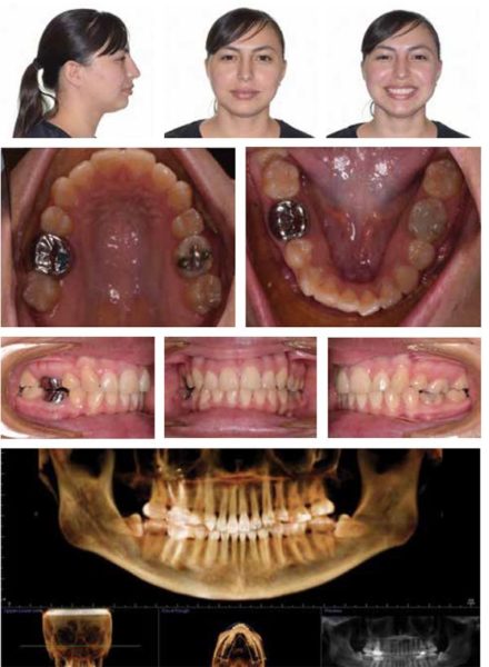 VPro5™ — more efficient aligner seating with high-frequency vibration ...