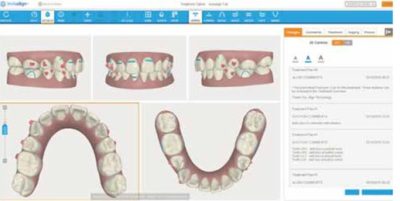 VPro5™ — more efficient aligner seating with high-frequency vibration ...