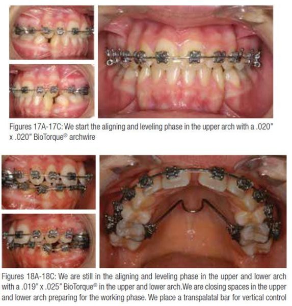 Maintaining clearly defined treatment objectives: part 2 Orthodontic ...