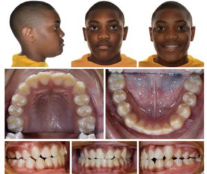 Management of facial asymmetries — true skeletal or functional shift ...