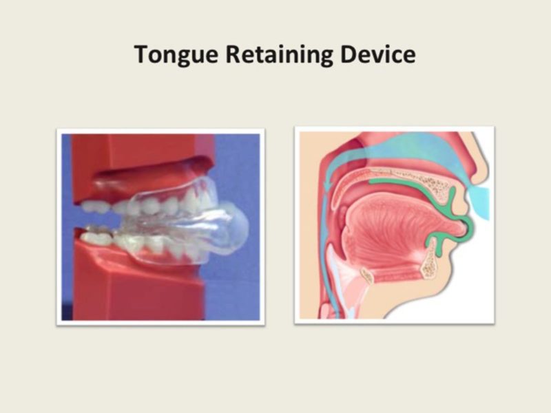 Orthodontic CE Article - A comparative review of mandibular advancement ...