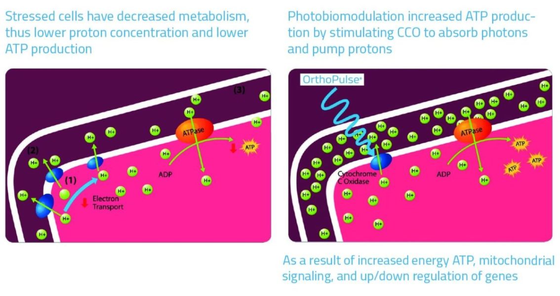 Accelerated orthodontics using photobiomodulation – Orthodontic Practice US