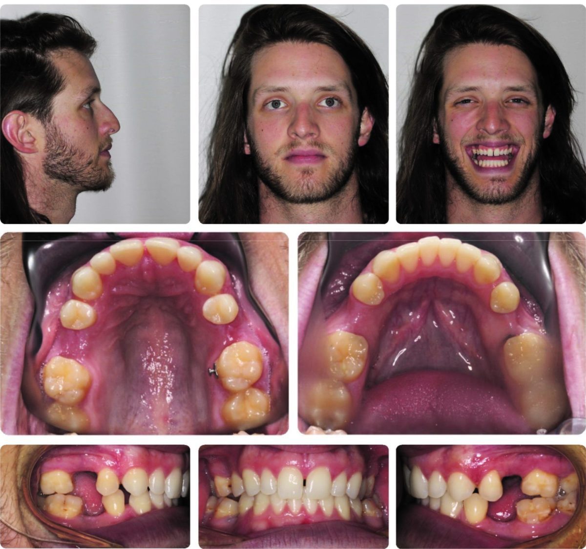 Accelerated orthodontics using photobiomodulation – Orthodontic Practice US