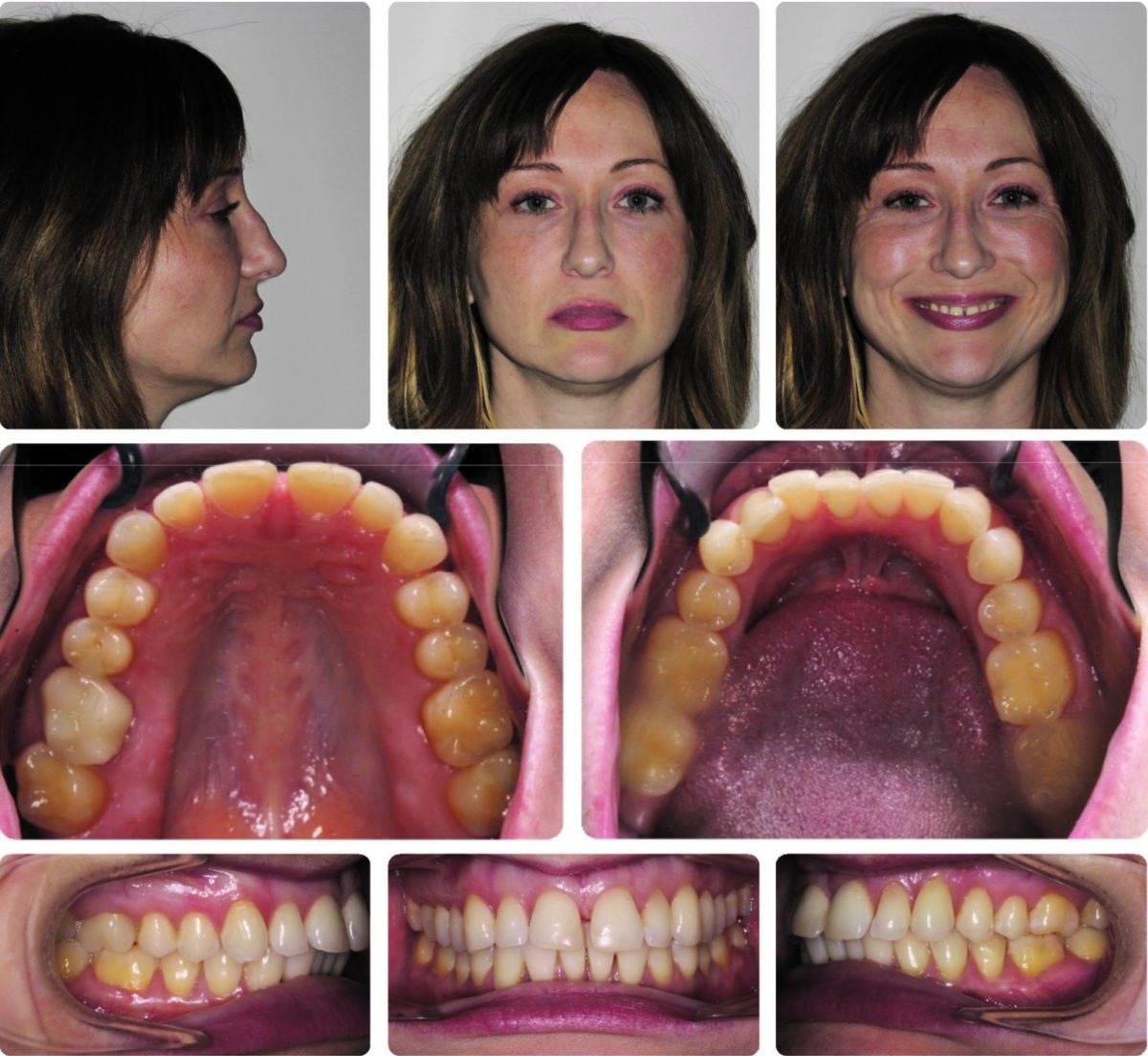 Accelerated orthodontics using photobiomodulation – Orthodontic Practice US