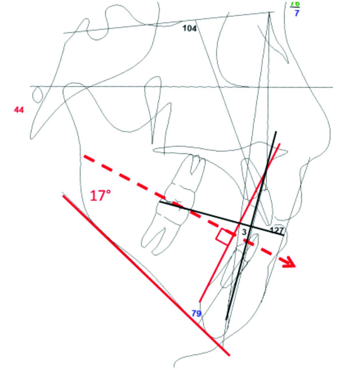 A modification of the Wits appraisal is proposed for patients with high ...