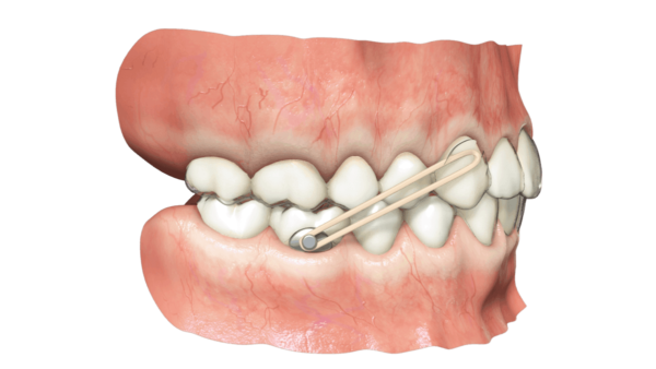 Orthodontic News - MidAtlantic Ortho Announces The Launch Of Precision ...