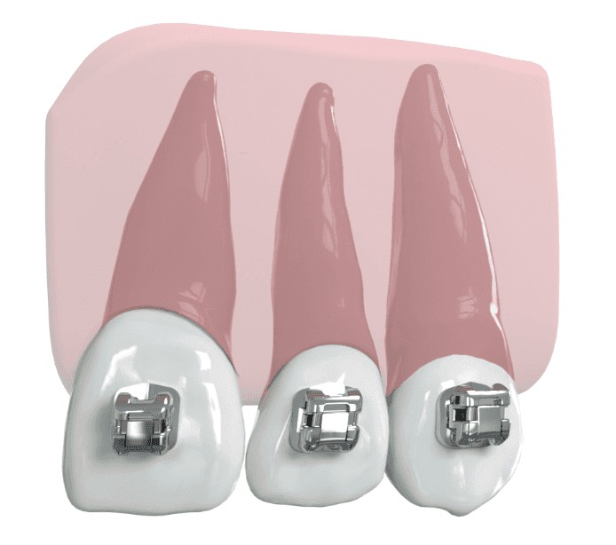 Damon™ Q2 — Ormco’s passive self-ligating bracket system | Orthodontic ...
