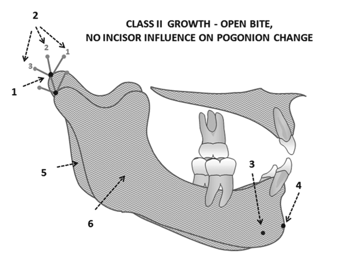 The importance of a certain type of mandibular growth on tooth movement ...