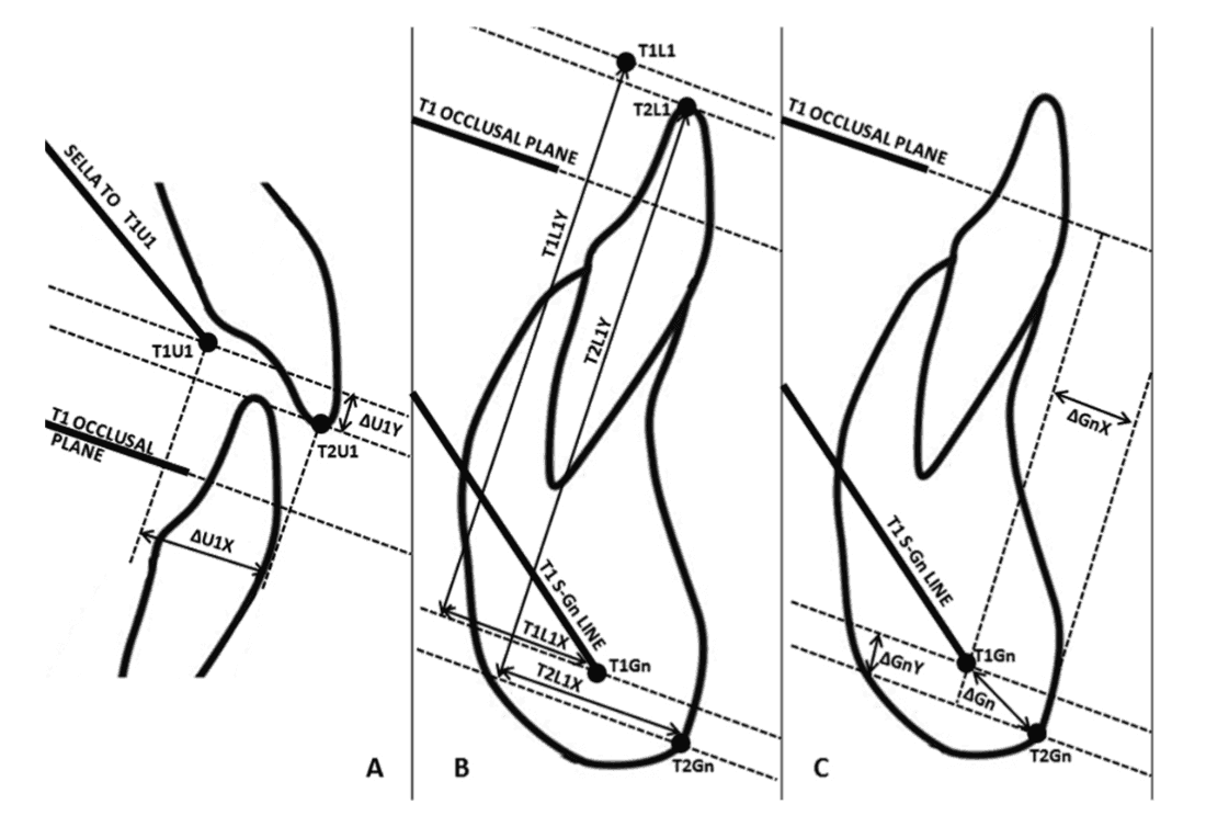 The importance of a certain type of mandibular growth on tooth movement ...