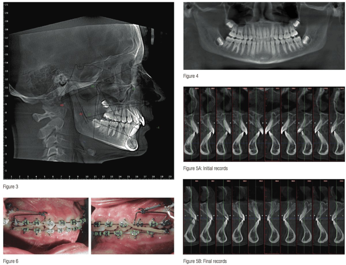 Using a treatment that produces the headgear effect | Orthodontic ...