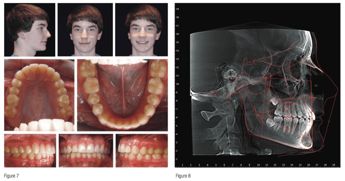 Using a treatment that produces the headgear effect | Orthodontic ...