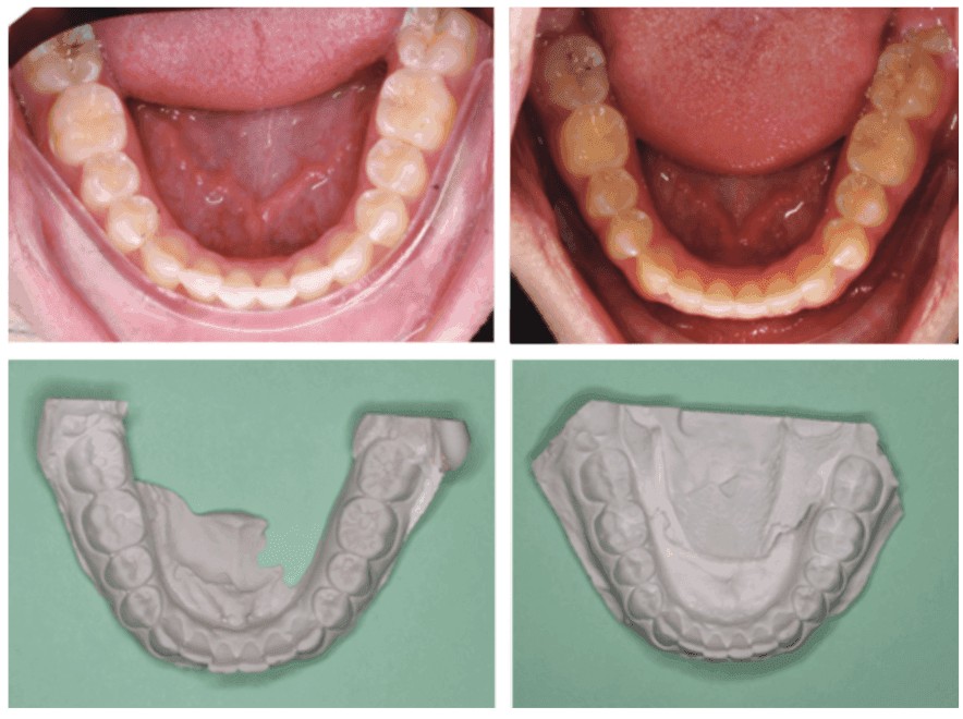 Thermoplastic aligners with dimples, predicable and cost-effective ... Thermoplastic aligners with dimples, predicable and cost-effective ...