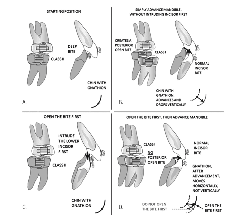 A study pertaining to the MARA device | Orthodontic Practice US
