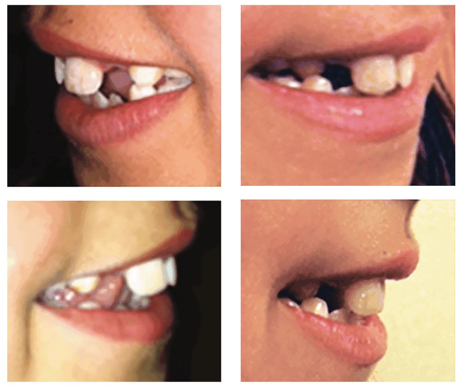 Myofunctional therapy — a benefit in addition to orthodontic therapy ...