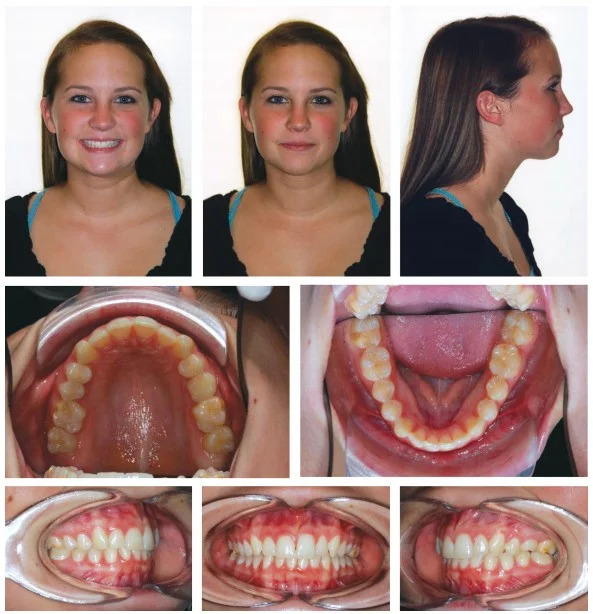 Dysfunctional condyle remodeling — successful conservative treatment