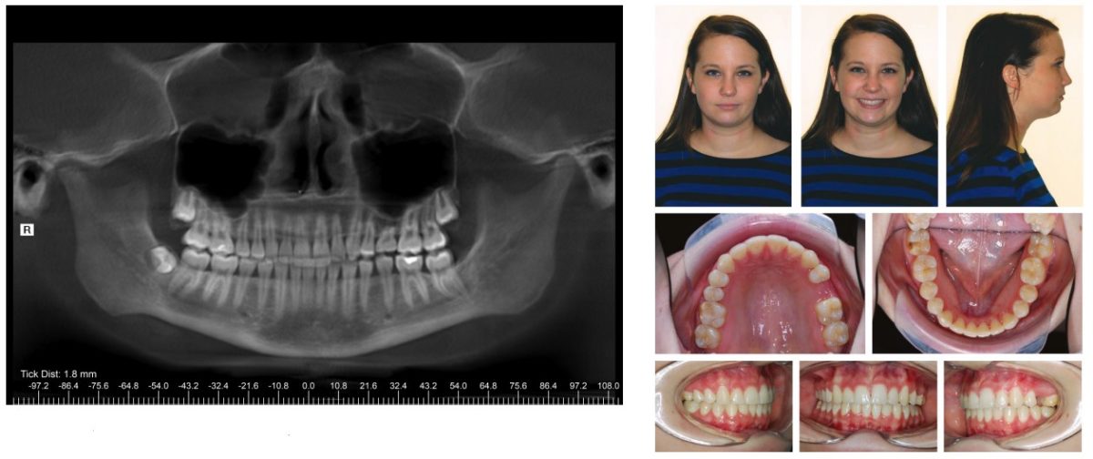 Dysfunctional condyle remodeling — successful conservative treatment