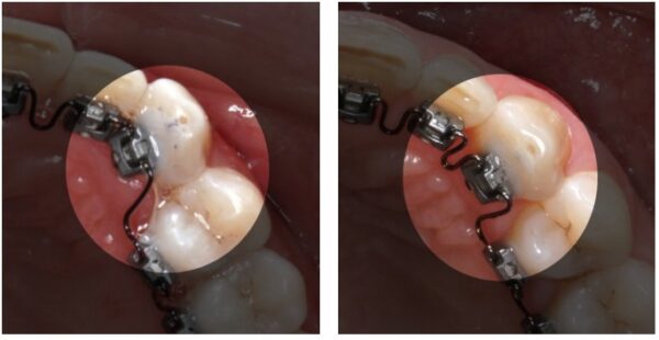 InBrace lingual braces — designed for efficiency