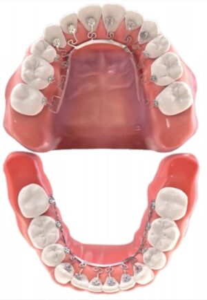 The BRIUS System — new CAD/CAM orthodontic treatment system