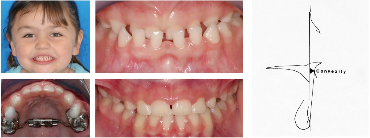 The airway benefit of Grummons Facemask therapy