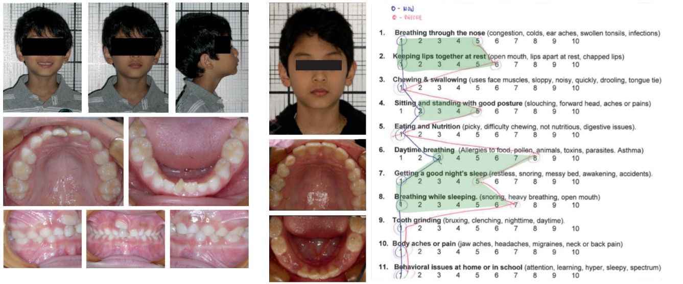 Airway Treatment In Orthodontics — Avoiding Chronic Threats to Breathing