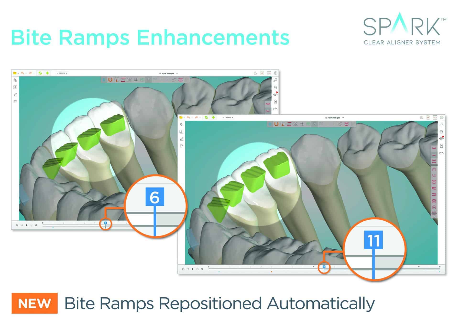 Orthodontic News - SPARK™ CLEAR ALIGNERS NEW RELEASE 12 GIVES DOCTORS ...