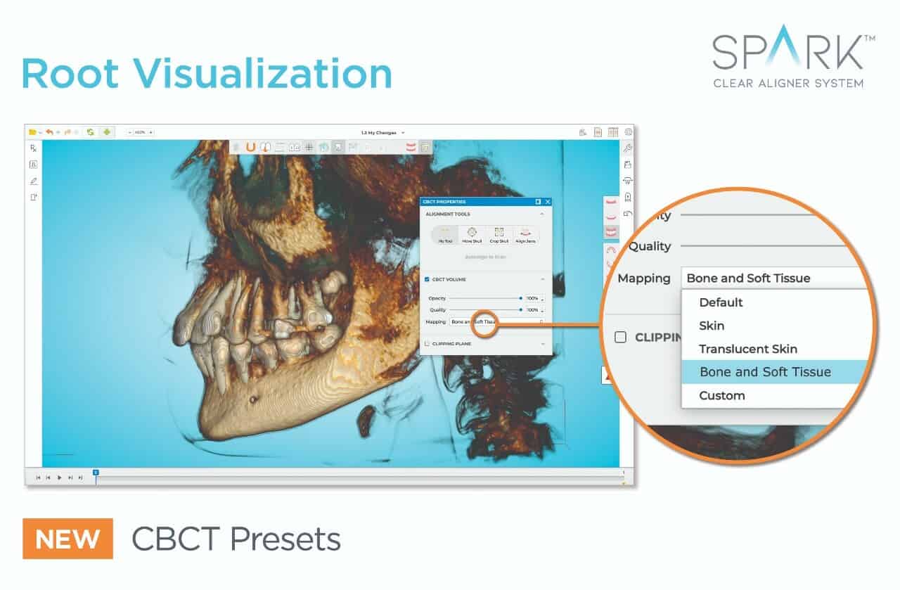 Orthodontic News - SPARK™ CLEAR ALIGNERS NEW RELEASE 12 GIVES DOCTORS ...