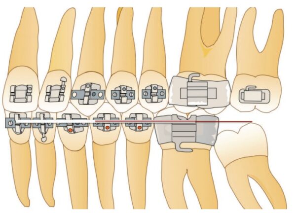 Impacted mandibular second molars — promising techniques for treatment