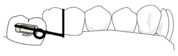 Impacted mandibular second molars — promising techniques for treatment