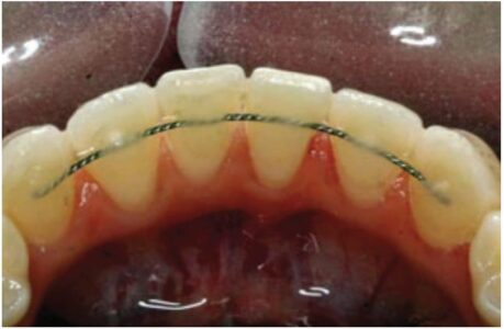 Orthodontic retention — an important focus for an orthodontic practice