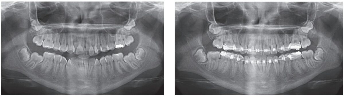 Impacted mandibular second molars — promising techniques for treatment