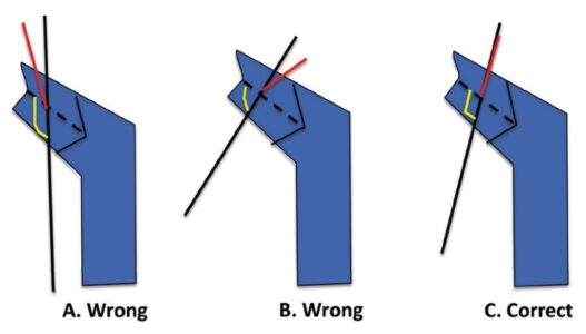 Bendistal pliers for permanent V-bends