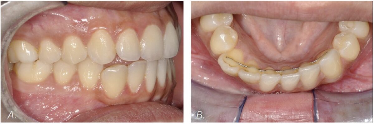 Orthodontic retention — an important focus for an orthodontic practice