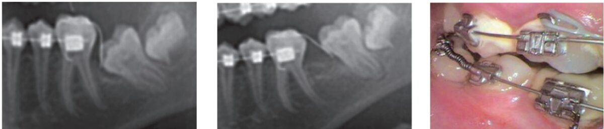 Impacted mandibular second molars — promising techniques for treatment