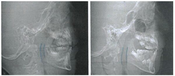 Airway issues— treated by orthodontics for young children
