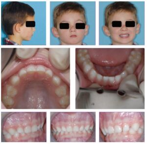 Airway issues— treated by orthodontics for young children
