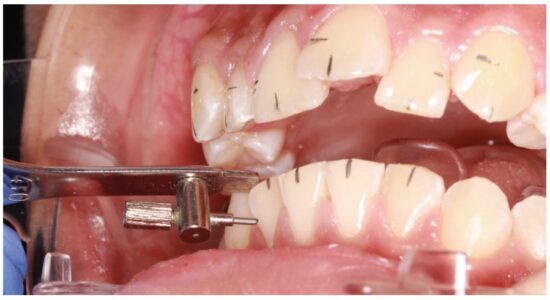 Proper bracket bonding avoids obstacles to better treatment outcomes