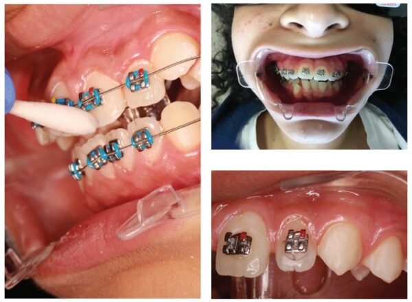 Proper bracket bonding avoids obstacles to better treatment outcomes