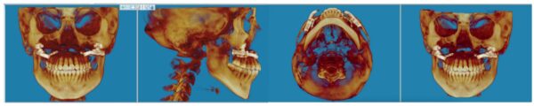 Orthodontists can partner for cleft palate treatment