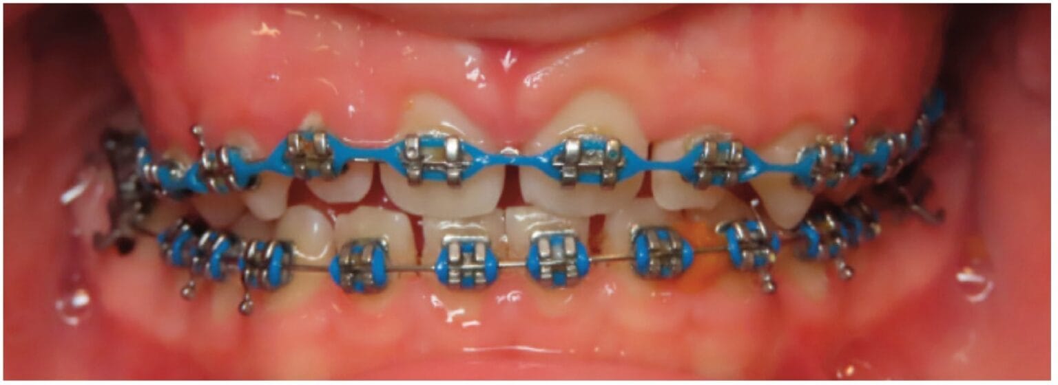 Myofunctional therapy — keeping relapse at bay