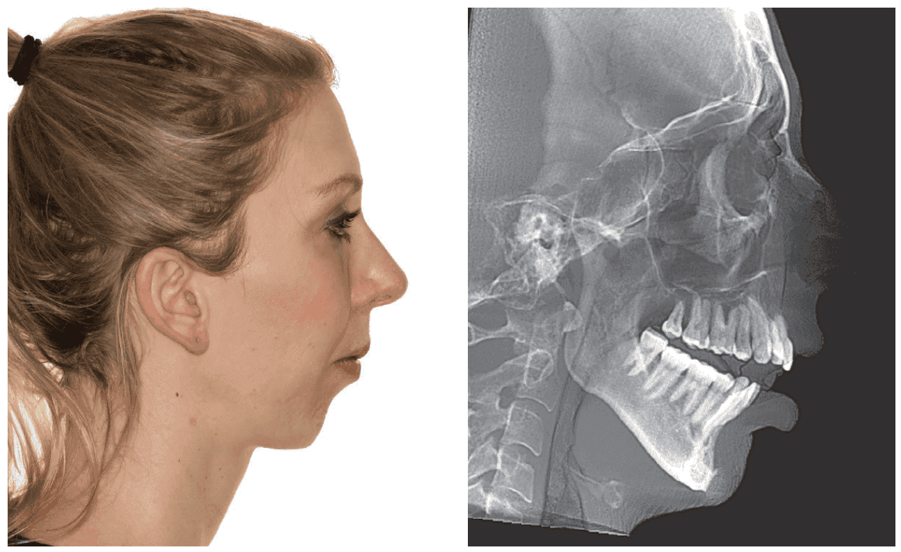 Lip closure — many impacts on health