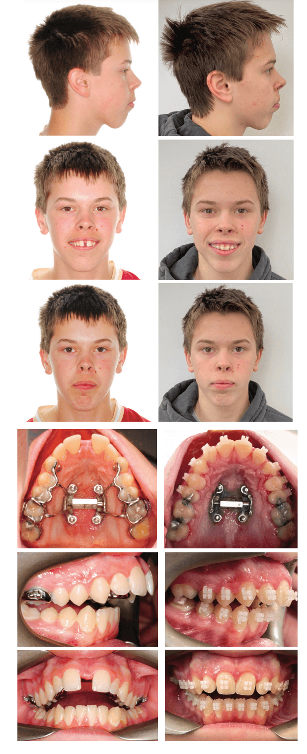 Precision orthodontics achieved for teen patients
