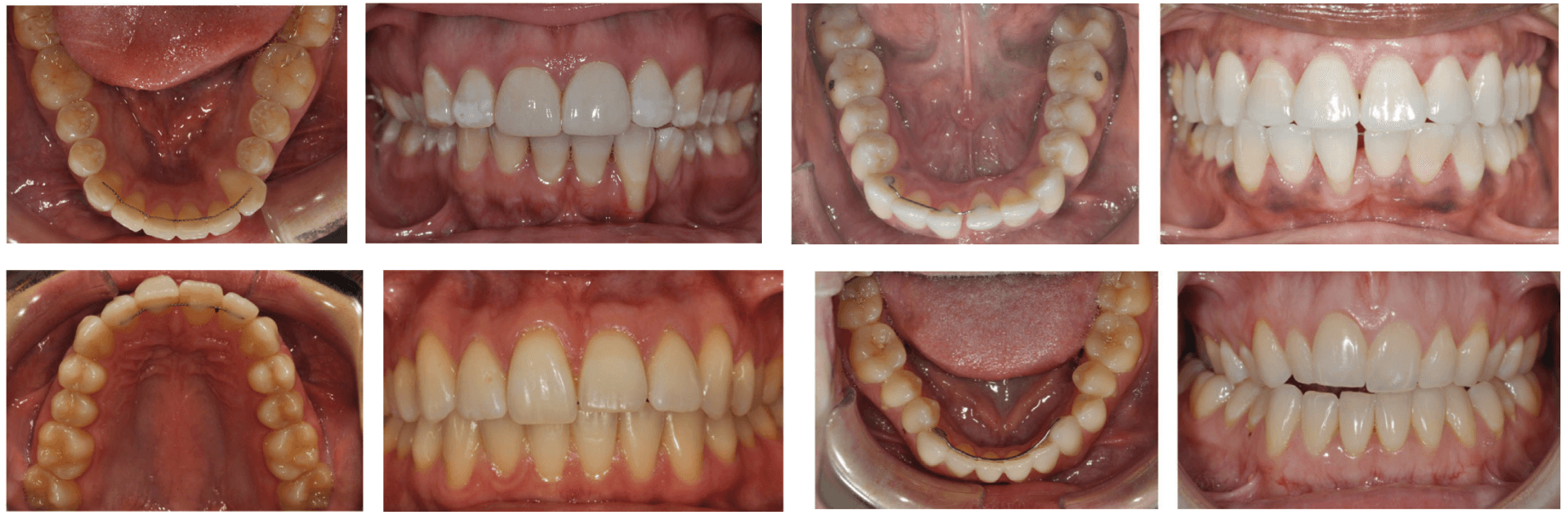 Orthodontic retention — maintaining patients’ treatment results