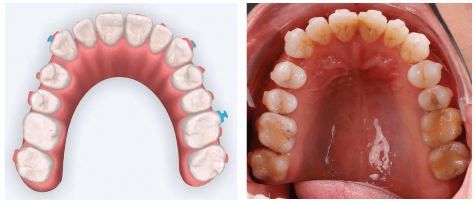 Angel Aligner — transforming approaches to complex cases