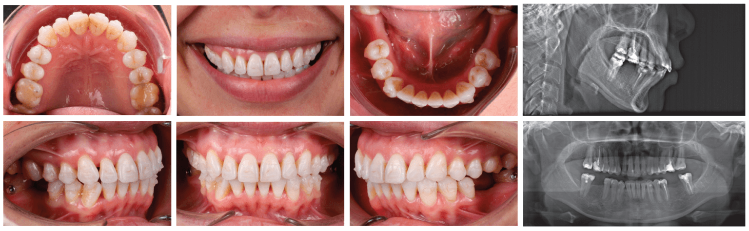 Angel Aligner — transforming approaches to complex cases