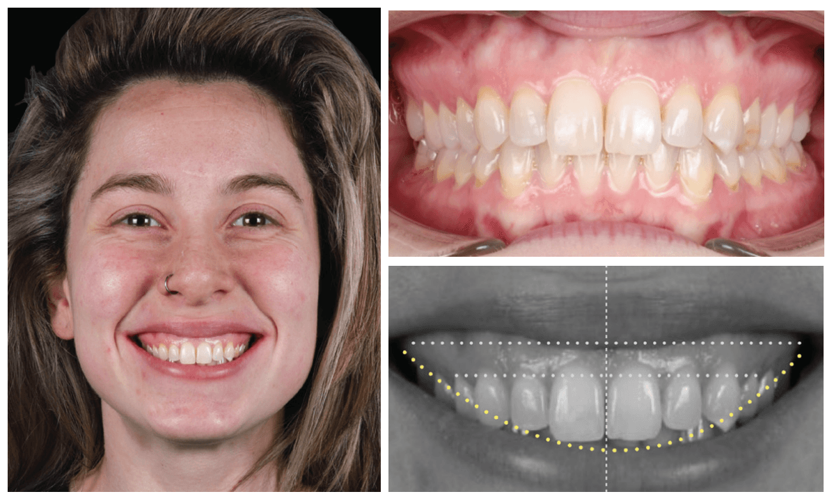 Angel Aligner — transforming approaches to complex cases